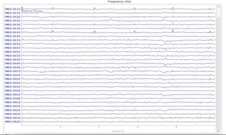 تحلیل سیگنال‌های MEG/EEG با کتابخانه MNE پایتون - آکادمی آنلاین مهندسی ...